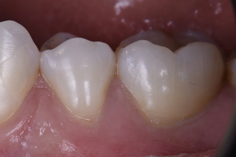 Bonding to Protect Sensitive Root Surfaces Bonding to Protect Sensitive ...