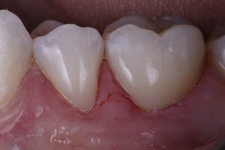 Bonding to Protect Sensitive Root Surfaces Bonding to Protect Sensitive ...