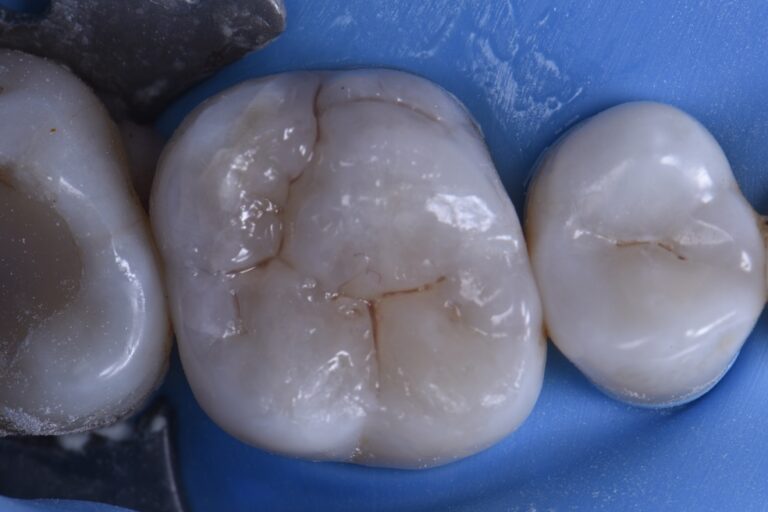 Hairline Fracture and Amalgam Removal Hairline Fracture and Amalgam Removal