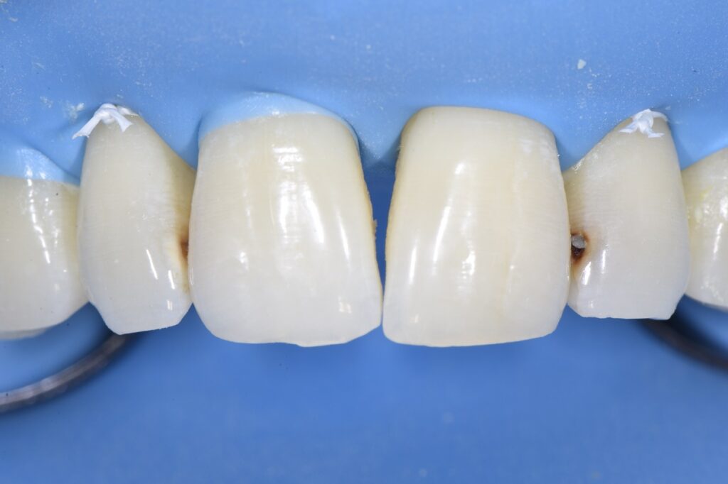 The use of single shade Supercomposites in Class III restorations The ...