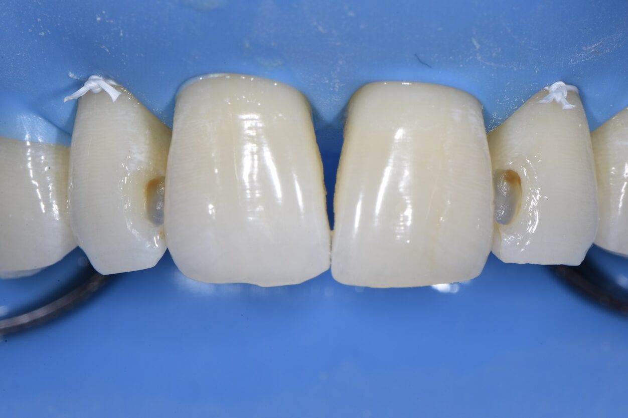 The use of single shade Supercomposites in Class III restorations The ...