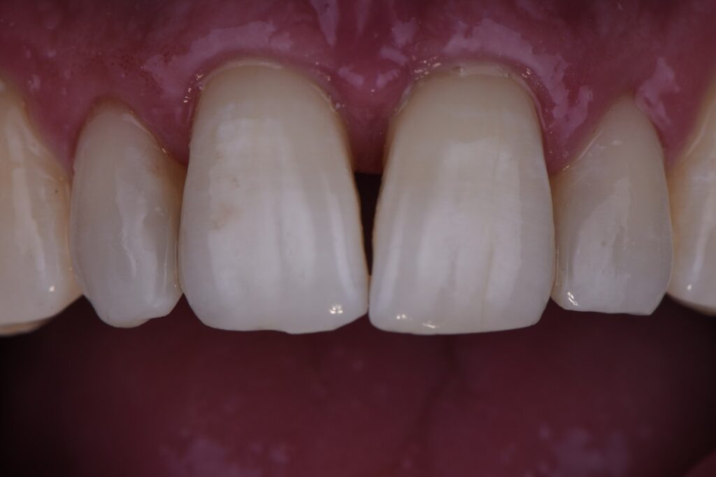 The use of single shade Supercomposites in Class III restorations The ...