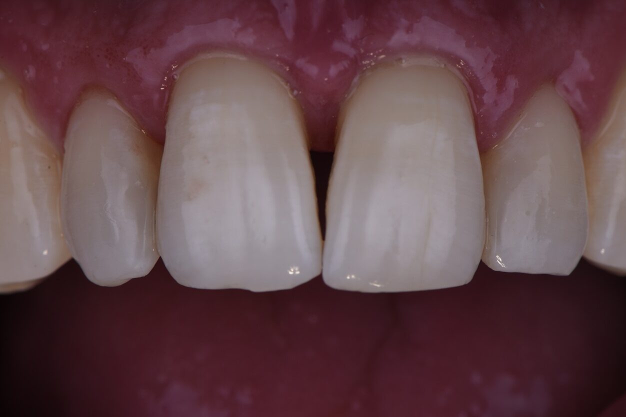 The use of single shade Supercomposites in Class III restorations The ...