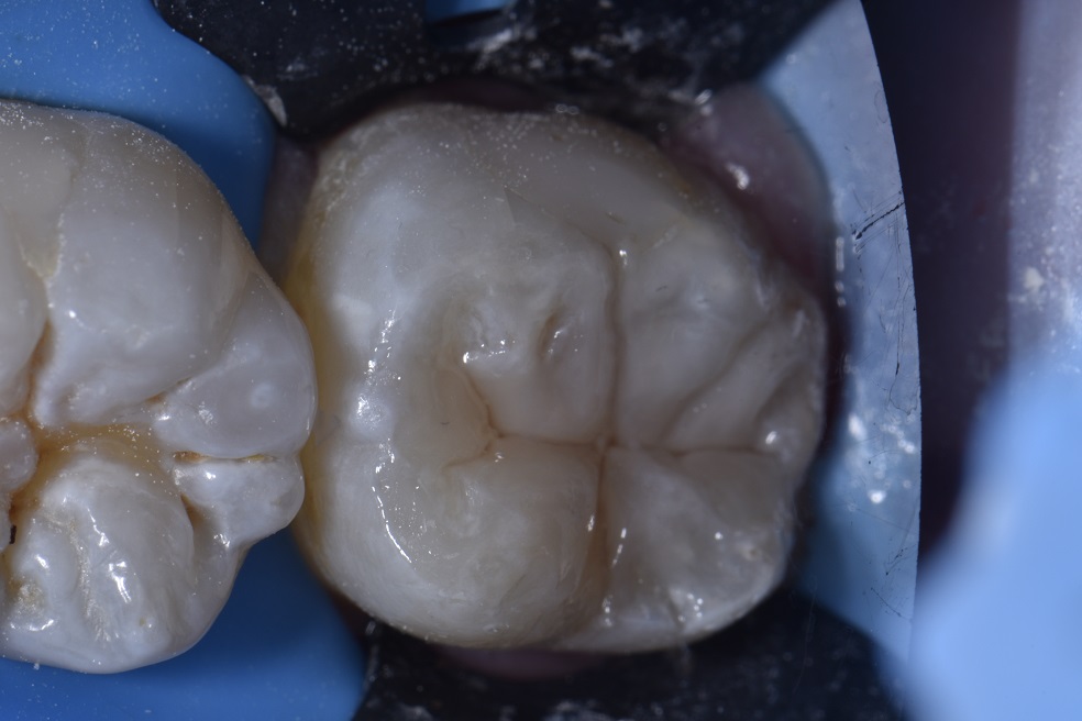 Replacement of old fillings due to marginal leakage with Voco Grandio ...