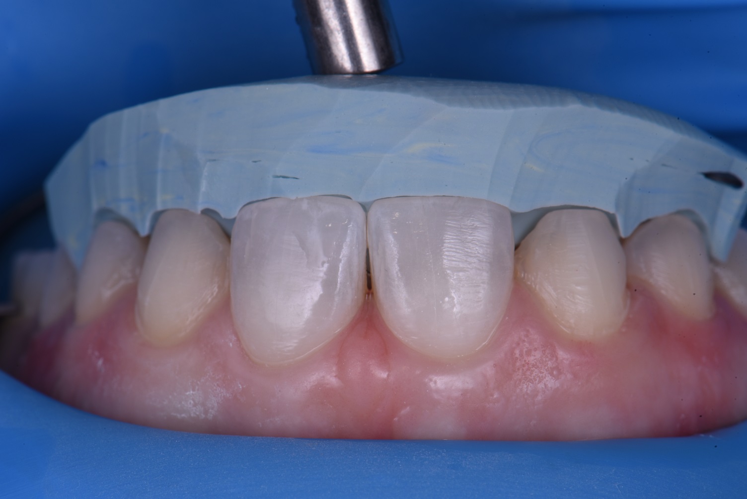 Auckland Dentist Digital Smile Design Composite Veneers Auckland ...