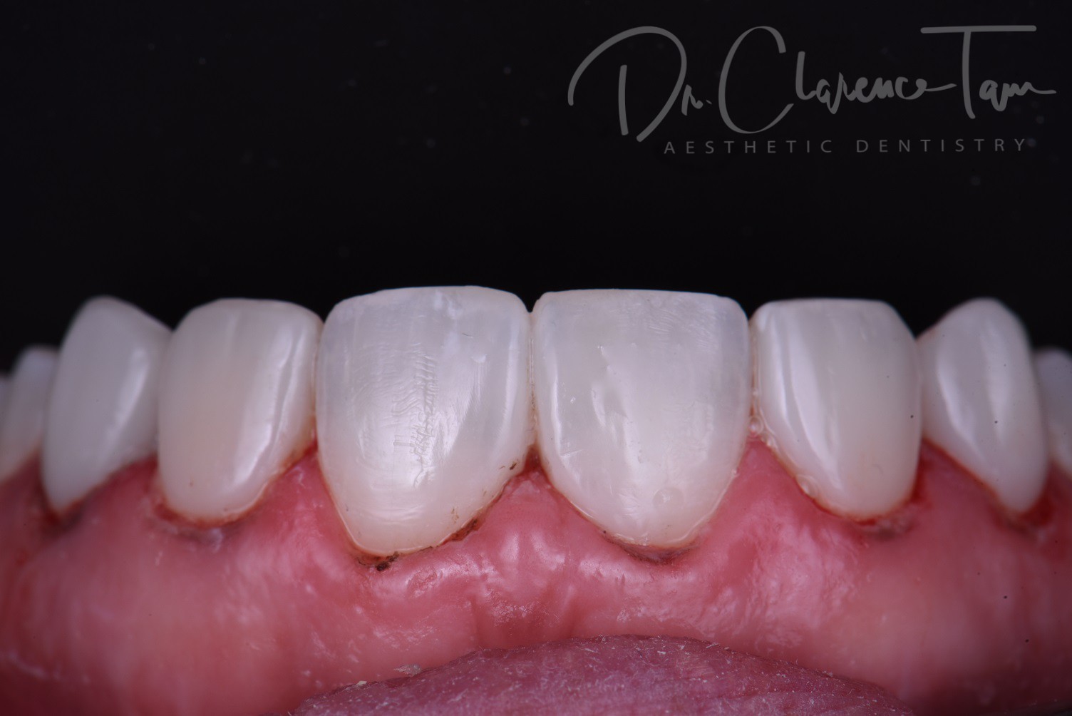 Auckland Dentist Digital Smile Design Composite Veneers Auckland ...