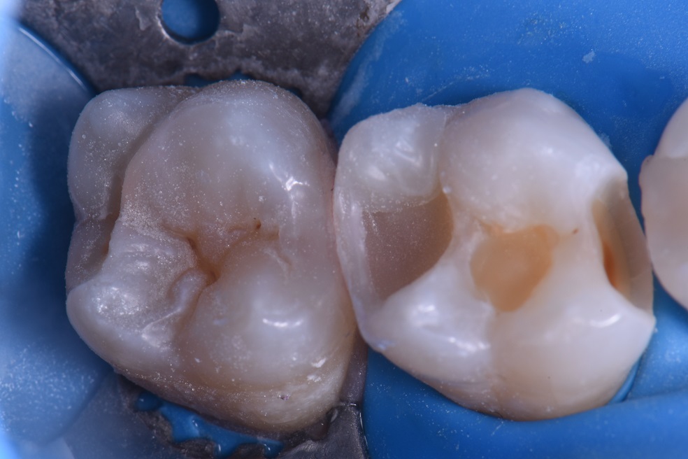 Large seamless composite restorations with anatomy Large seamless ...