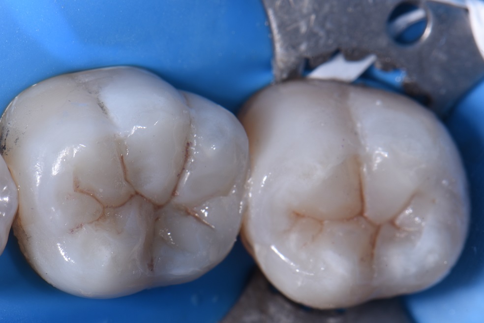 Neutralizing Amalgam Stained Teeth with Composite Neutralizing Amalgam ...