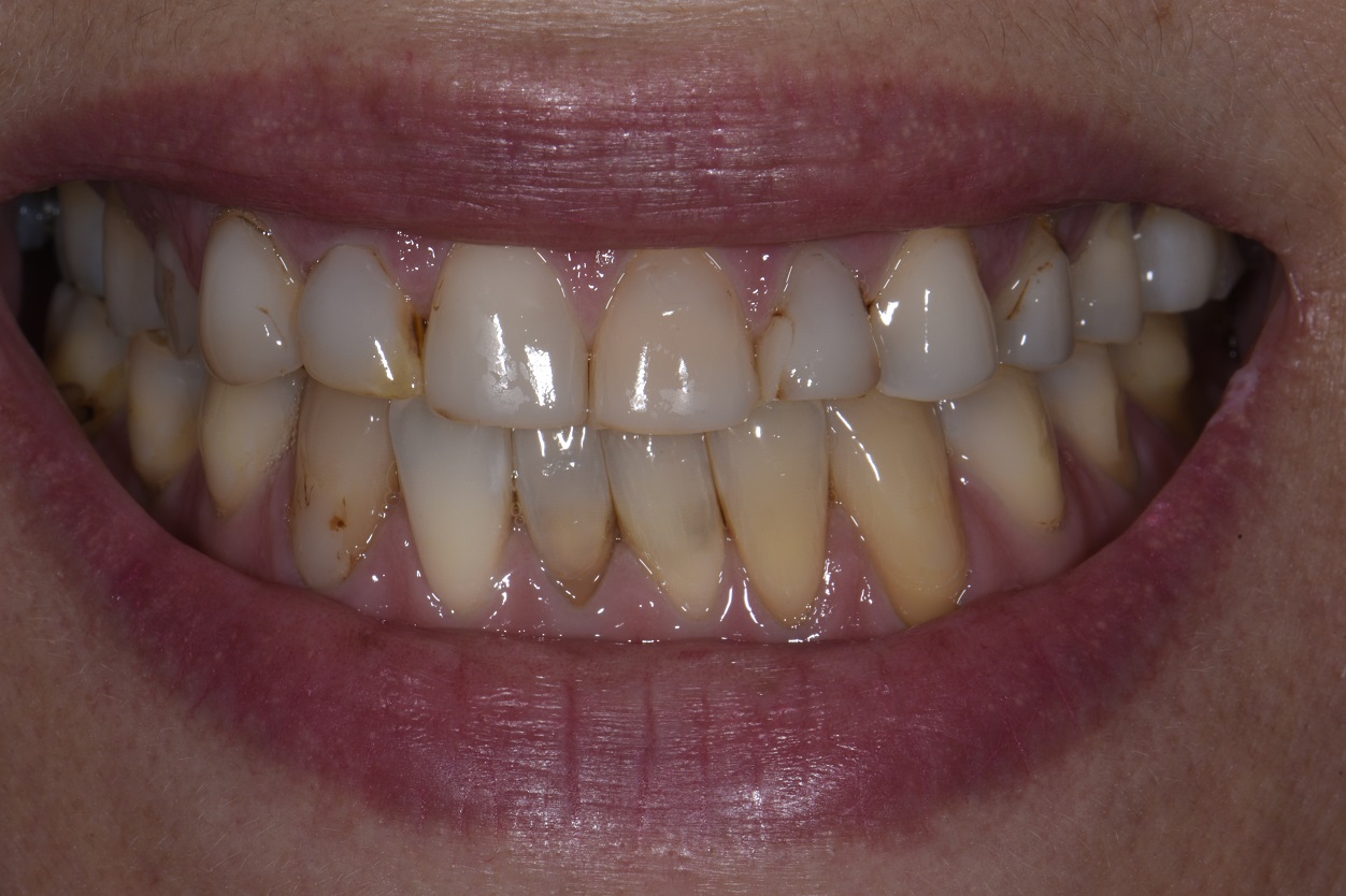 Ultradent Mosaic Composite Veneers DSD Driven Ultradent Mosaic ...