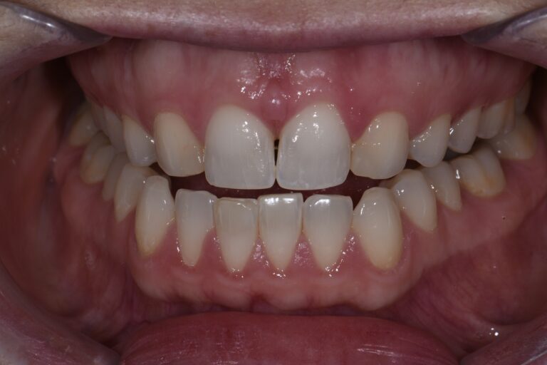 Composite Veneers in the Social Six Composite Veneers in the Social Six