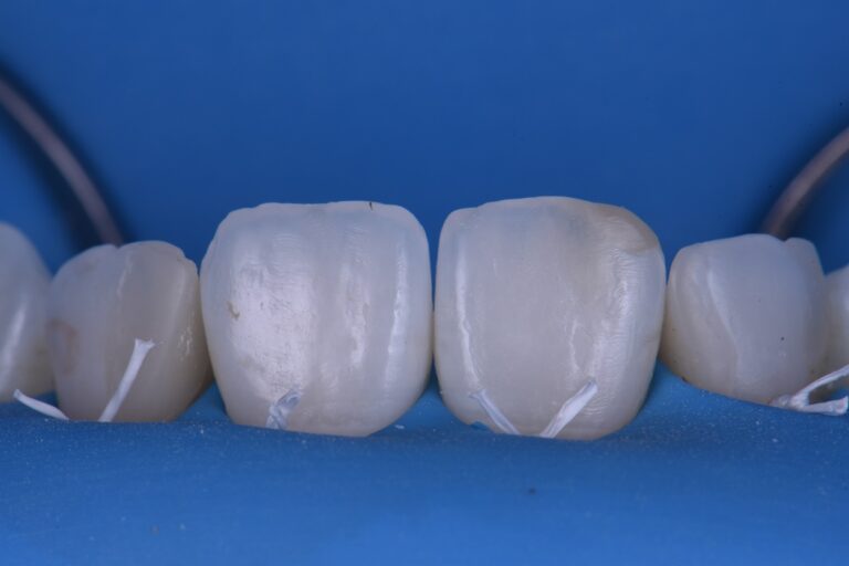 Composite Replacement Restorations Kerr Harmonize Composite Replacement ...