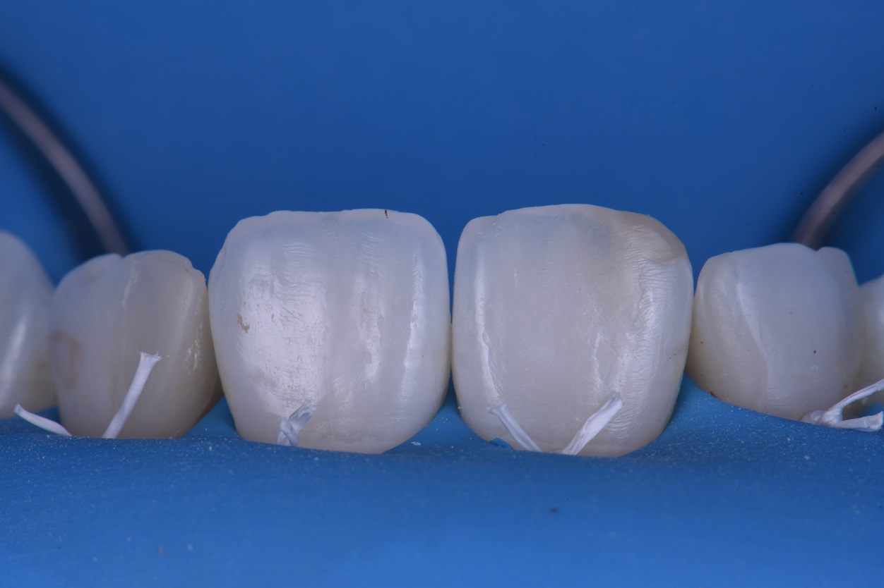 Composite Replacement Restorations Kerr Harmonize Composite Replacement ...