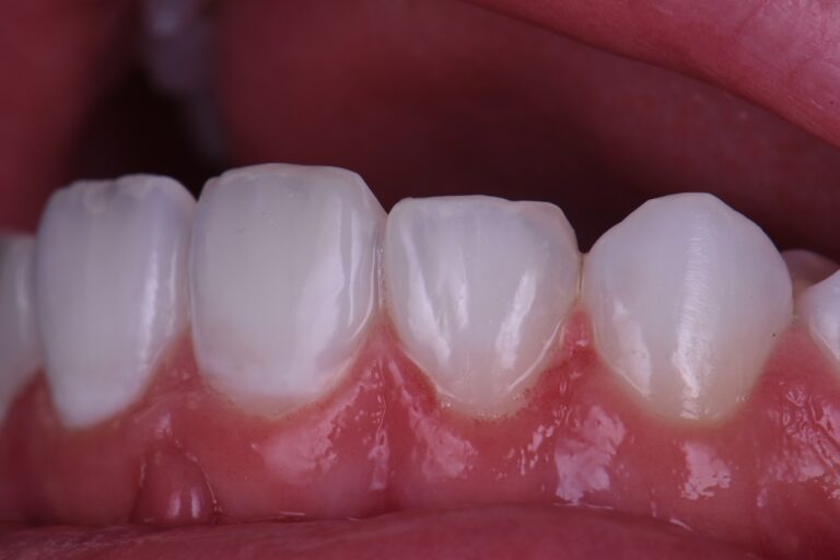 Composite Replacement Restorations Kerr Harmonize Composite Replacement ...