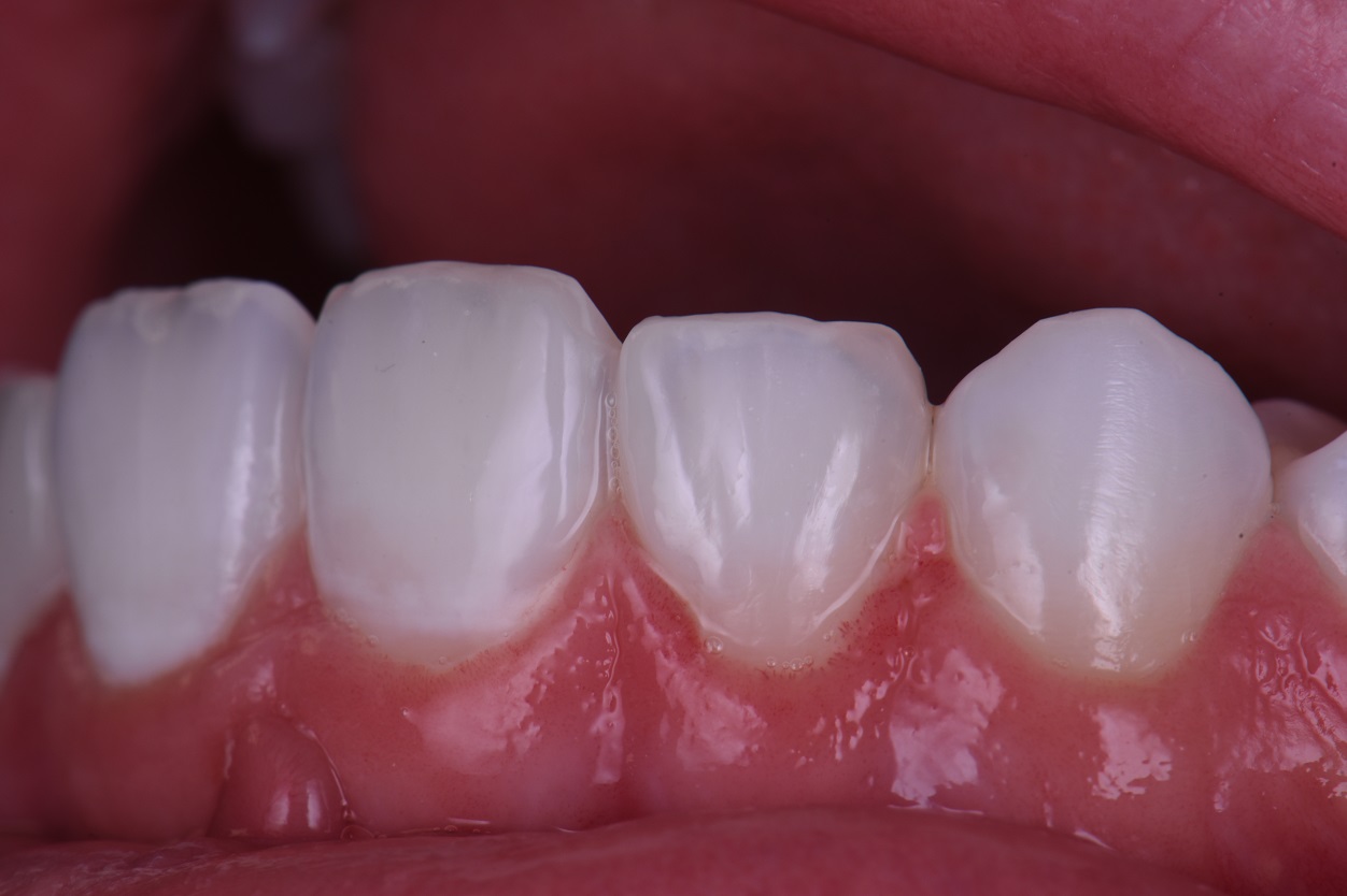 Composite Replacement Restorations Kerr Harmonize Composite Replacement ...