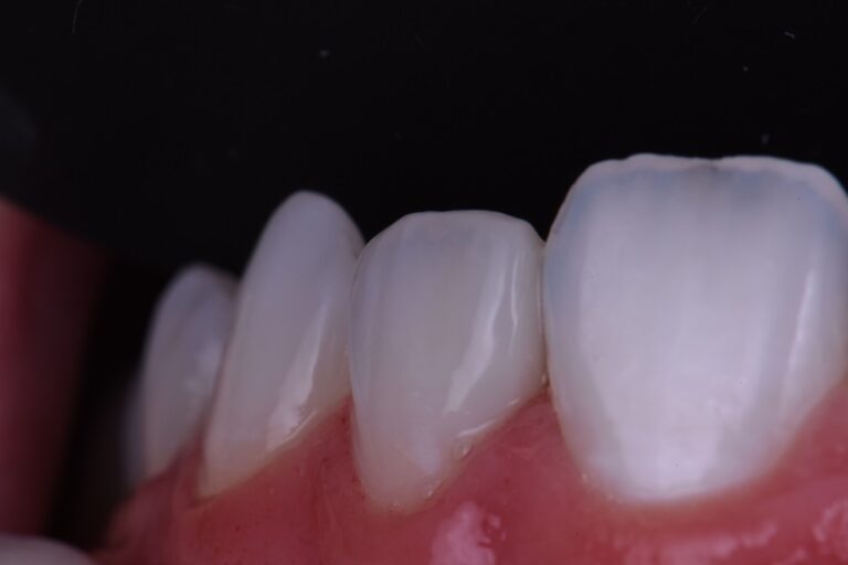 Composite Replacement Restorations Kerr Harmonize Composite Replacement ...