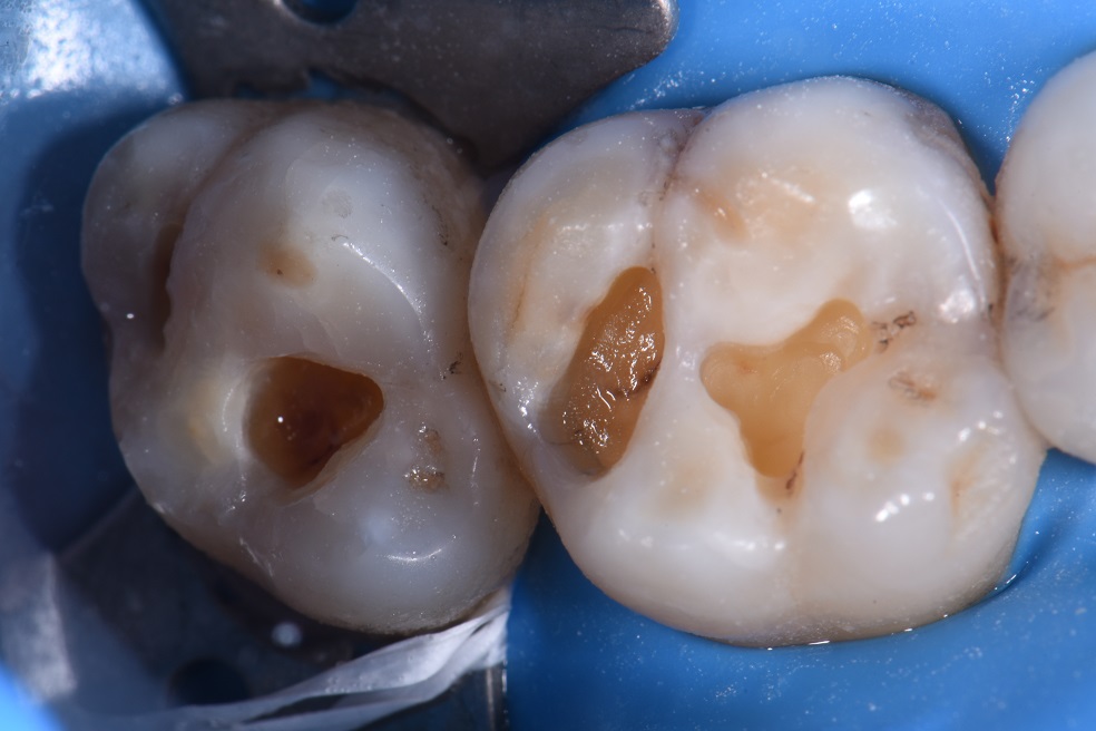 Deep cavities restored with a single shade of a supercomposite Deep ...