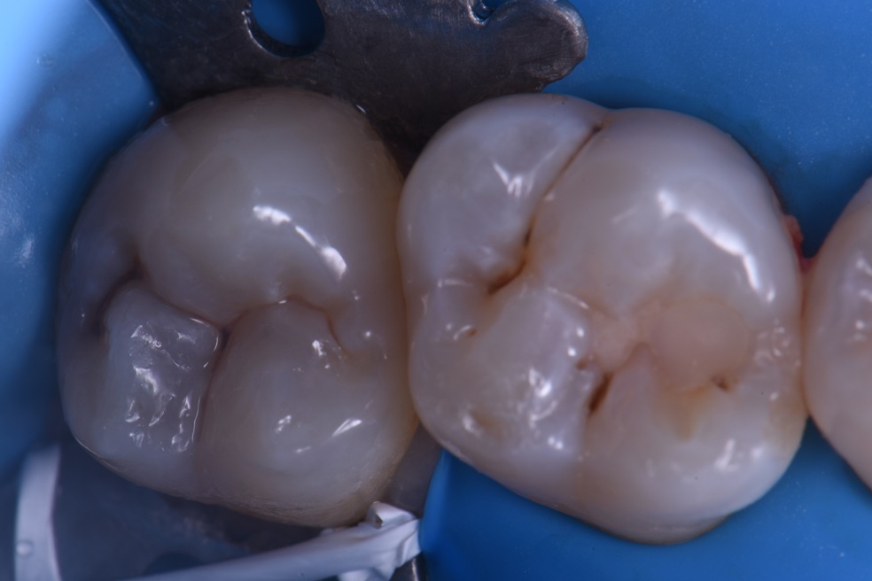 Voco Grandio SO restoration of deep cavities Voco Grandio SO ...