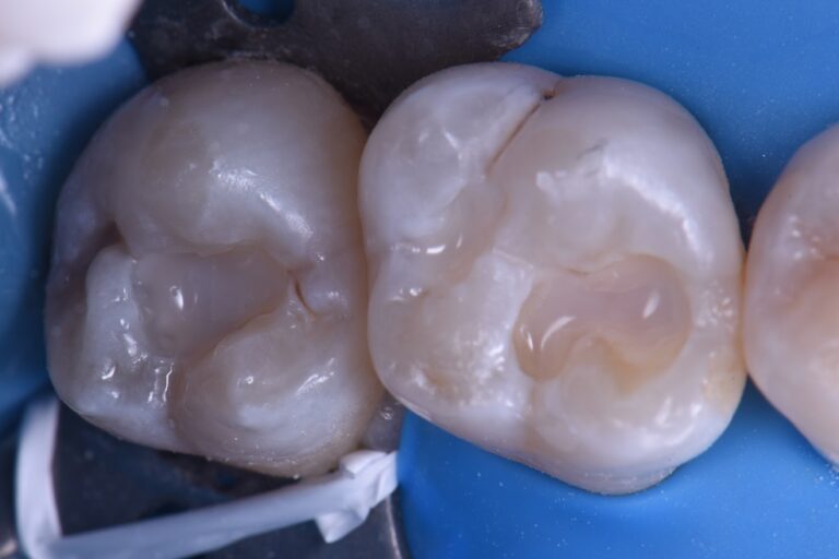 Voco Grandio SO restoration of deep cavities Voco Grandio SO ...