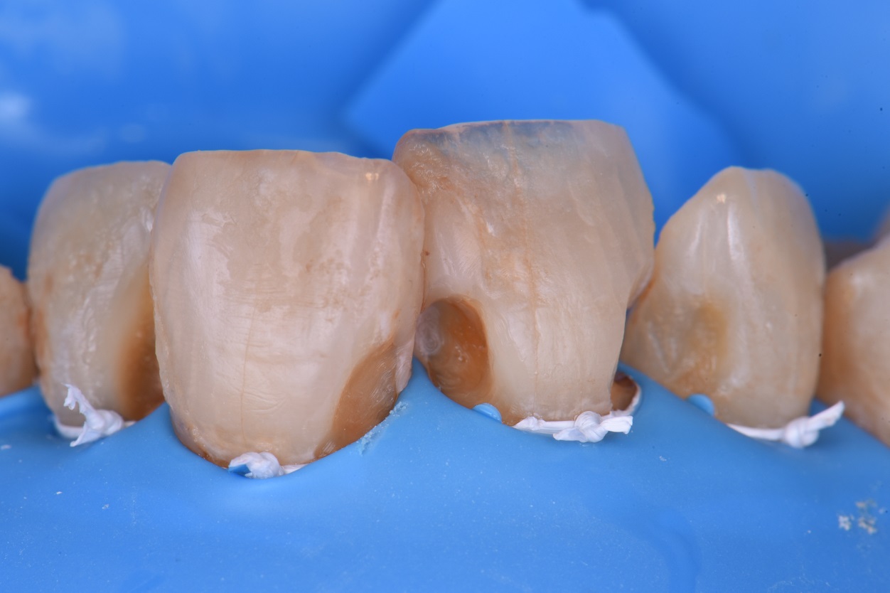 Rampant cavities in the smile zone restored Rampant cavities in the ...