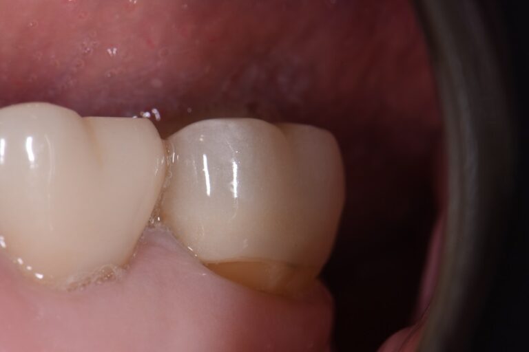 Restoring Class V abrasions below emax crown Restoring Class V ...
