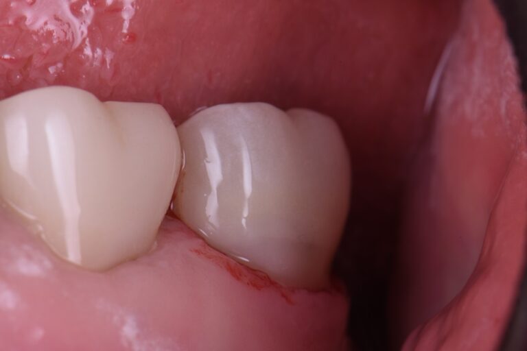 Restoring Class V abrasions below emax crown Restoring Class V ...