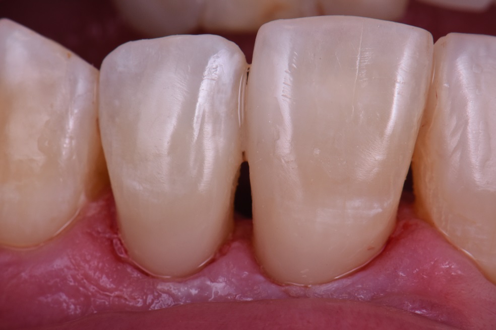 Gaenial A’Chord root caries and abrasion restorations Gaenial A'Chord ...