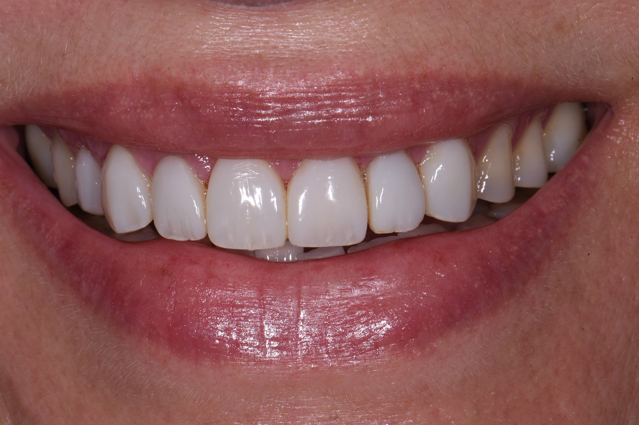 Ultradent Mosaic Composite Veneers DSD Driven Ultradent Mosaic ...