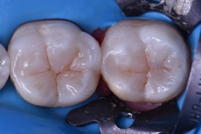 Cloud shaded posterior composite anatomy Cloud shaded posterior ...