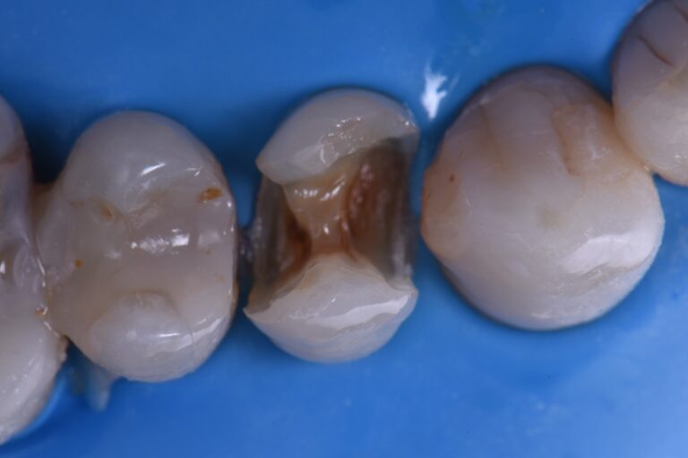 Premolar Extensive Caries with Well Blended Composite Restoration ...