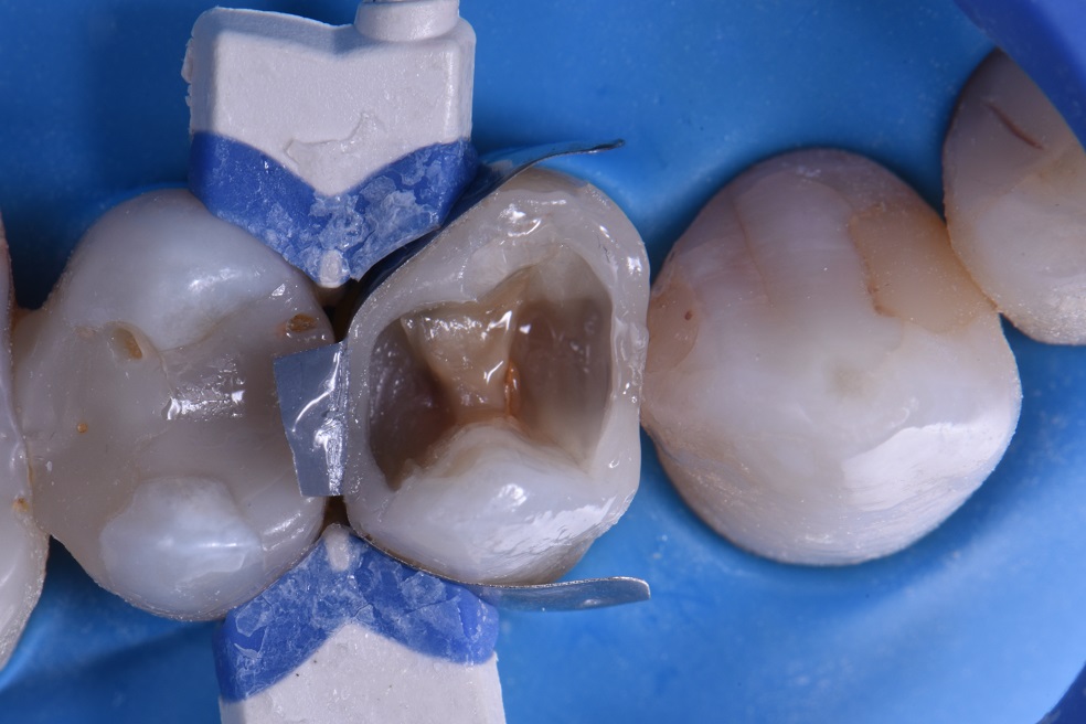 Premolar Extensive Caries with Well Blended Composite Restoration ...