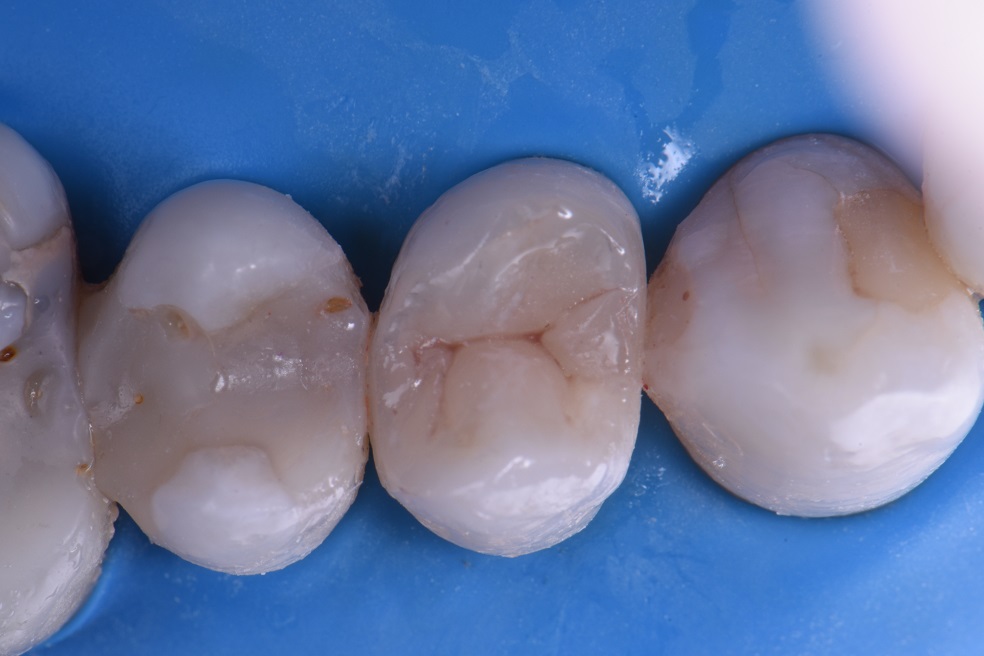Premolar Extensive Caries with Well Blended Composite Restoration ...
