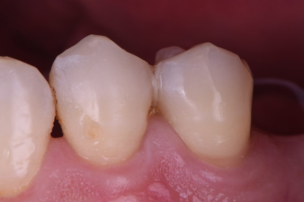 Class V lesions restored invisibly Class V lesions restored invisibly