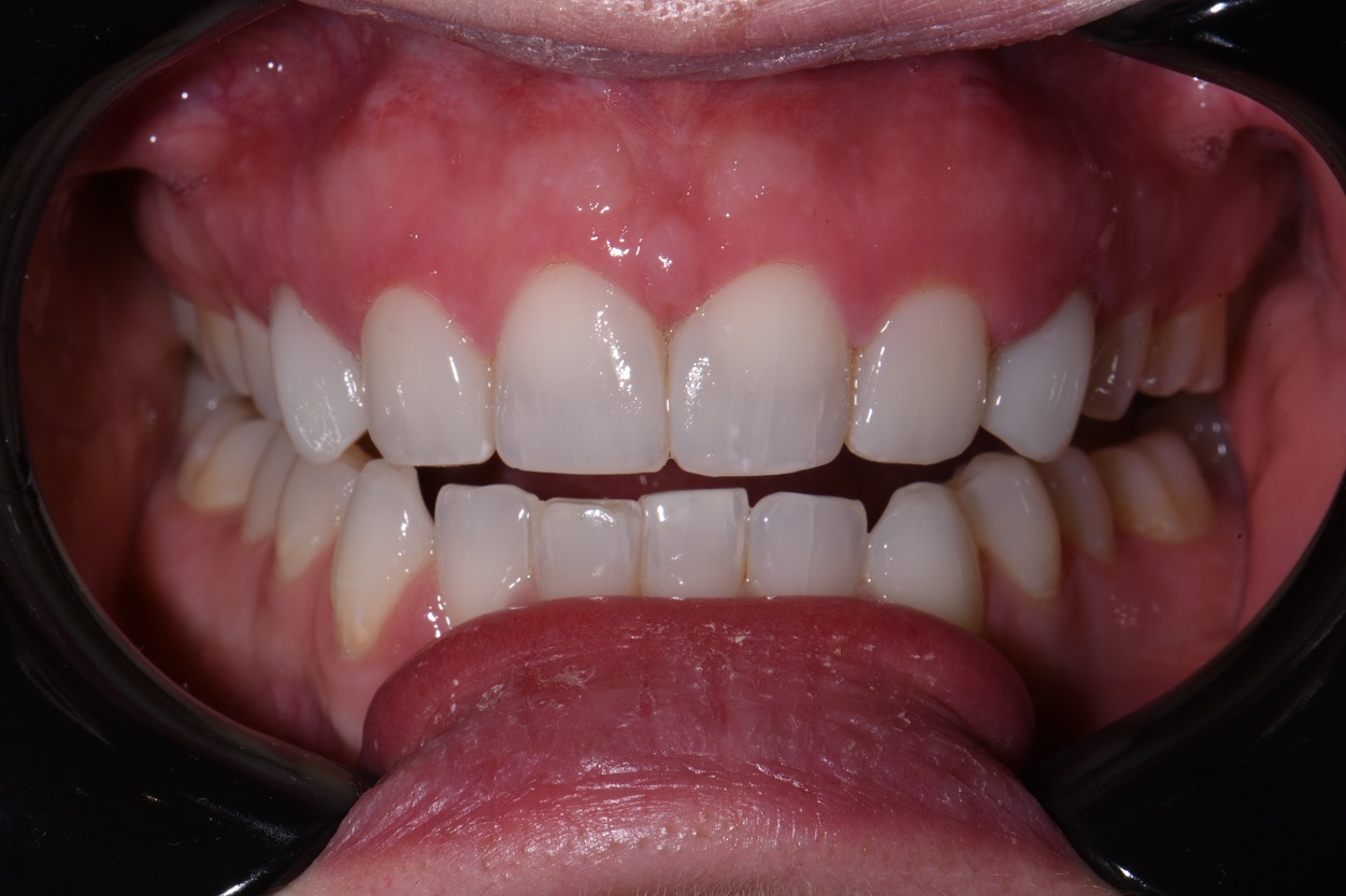 Composite Veneers in the Social Six Composite Veneers in the Social Six
