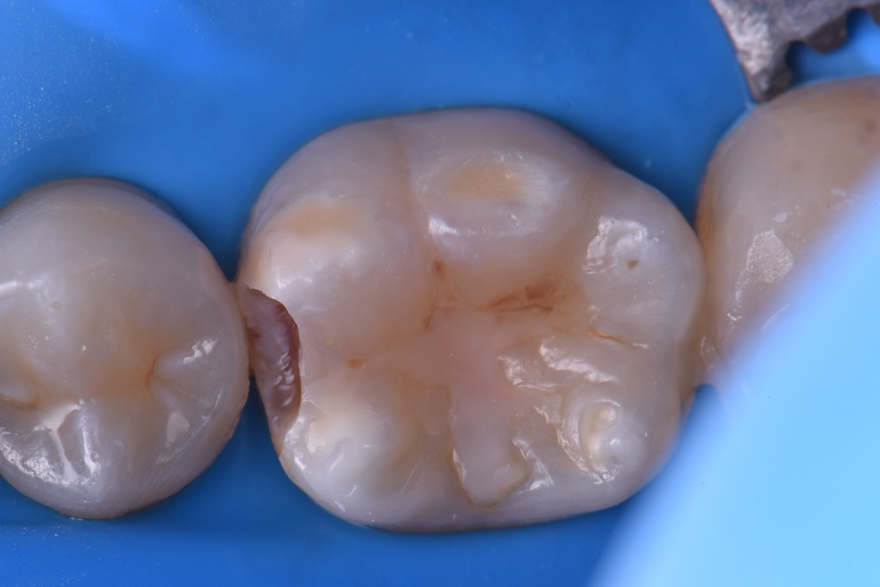 Treating secondary decay on a hypomineralized molar Treating secondary ...