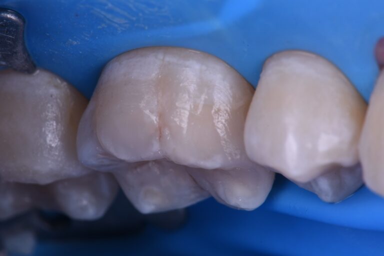 Treating secondary decay on a hypomineralized molar Treating secondary ...