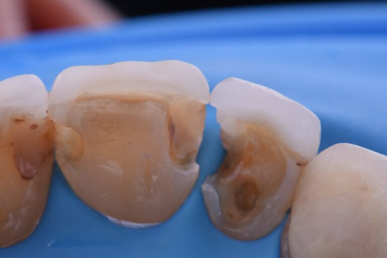 Garrison Fusion Anterior Matrix System First Case Garrison Fusion ...