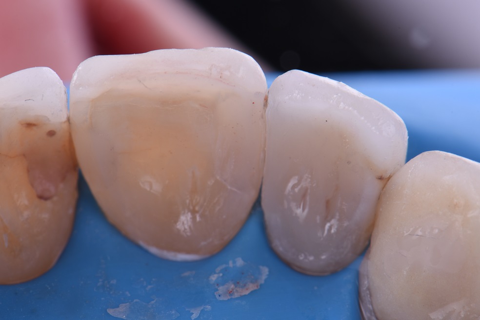 Garrison Fusion Anterior Matrix System First Case Garrison Fusion ...