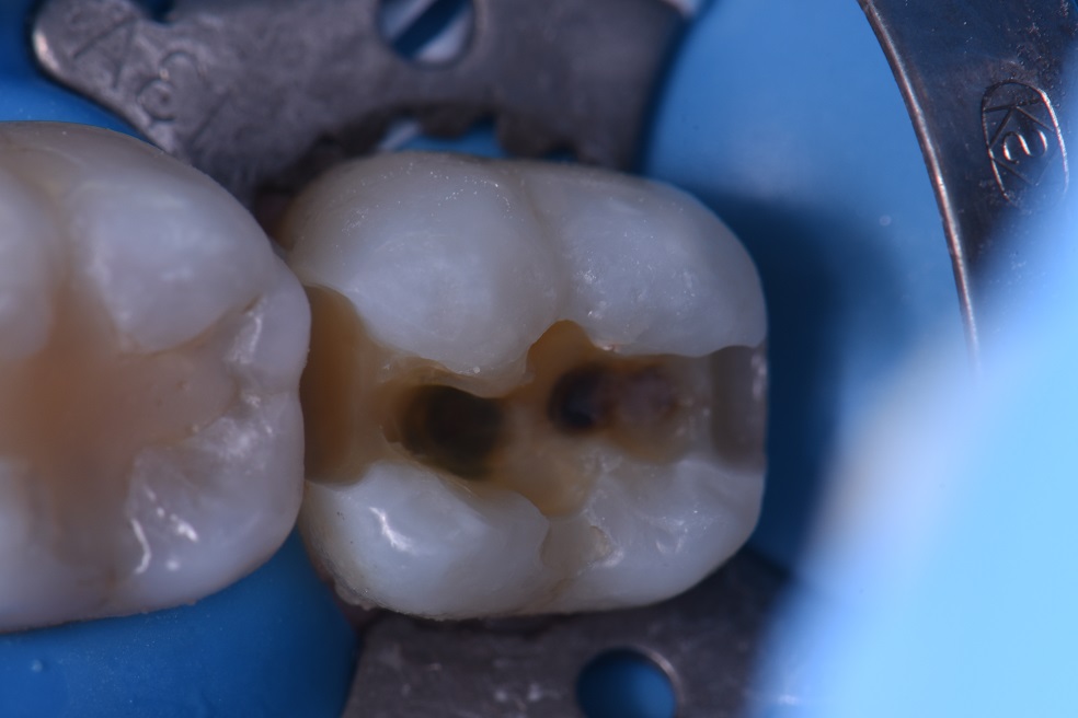 Crack Removal in Teeth Crack Removal in Teeth