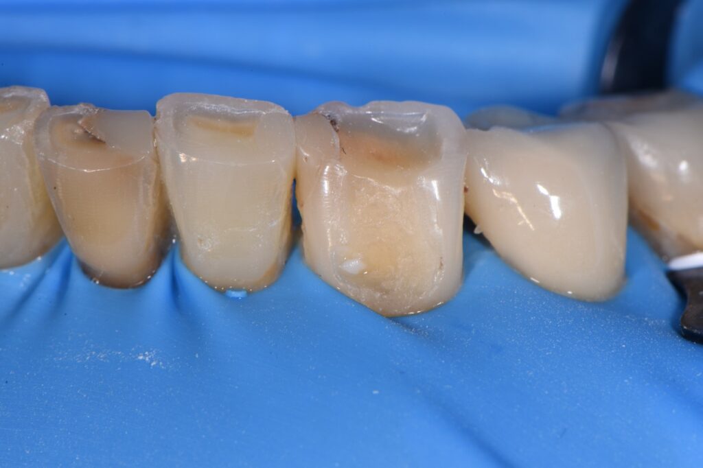 Hu-Friedy Akroflex | Garrison Fusion Anterior Matrix | Ultradent ...