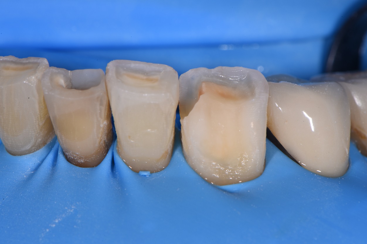 Hu-Friedy Akroflex | Garrison Fusion Anterior Matrix | Ultradent ...