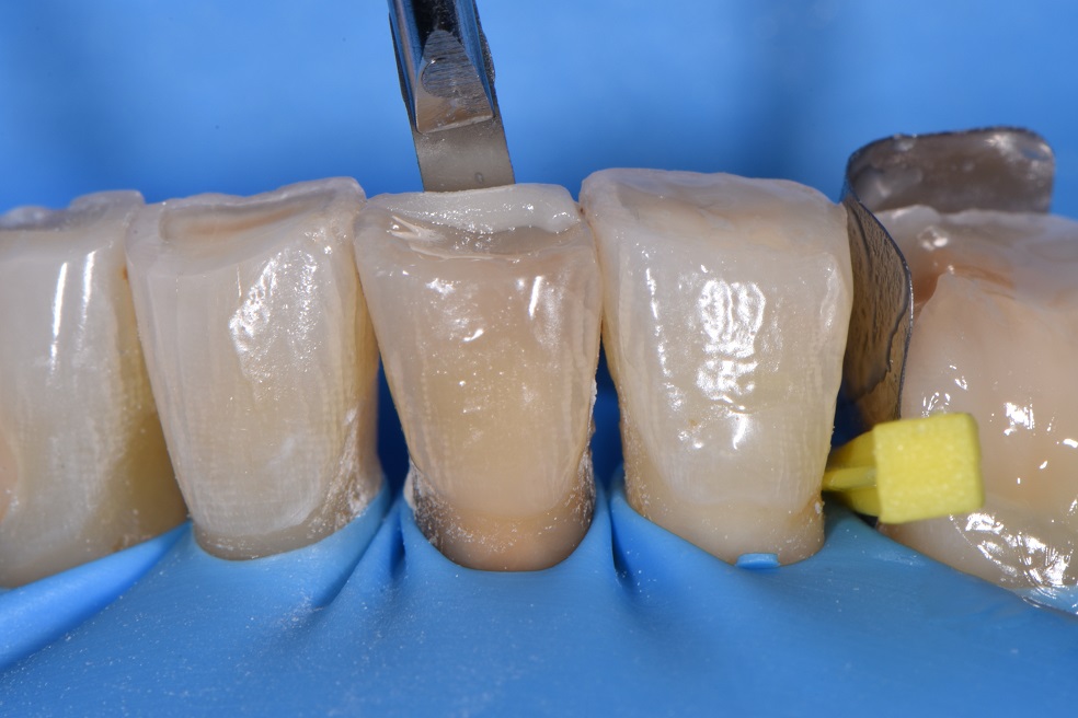 Hu-Friedy Akroflex | Garrison Fusion Anterior Matrix | Ultradent ...