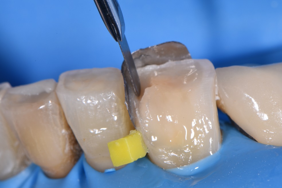 Hu-Friedy Akroflex | Garrison Fusion Anterior Matrix | Ultradent ...