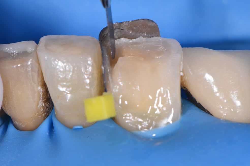 Hu-Friedy Akroflex | Garrison Fusion Anterior Matrix | Ultradent ...