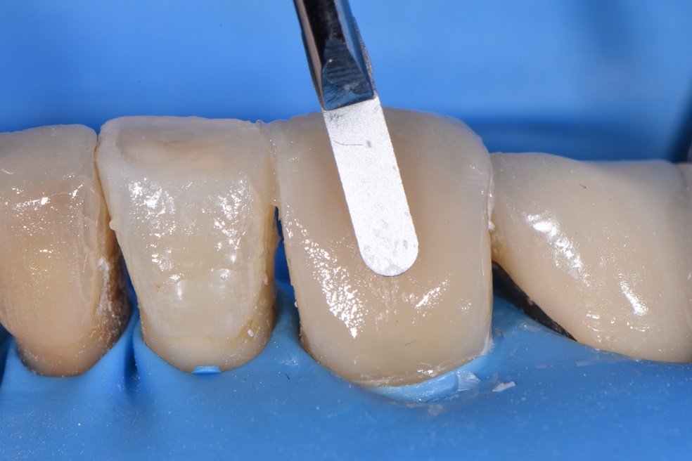 Hu-Friedy Akroflex | Garrison Fusion Anterior Matrix | Ultradent ...