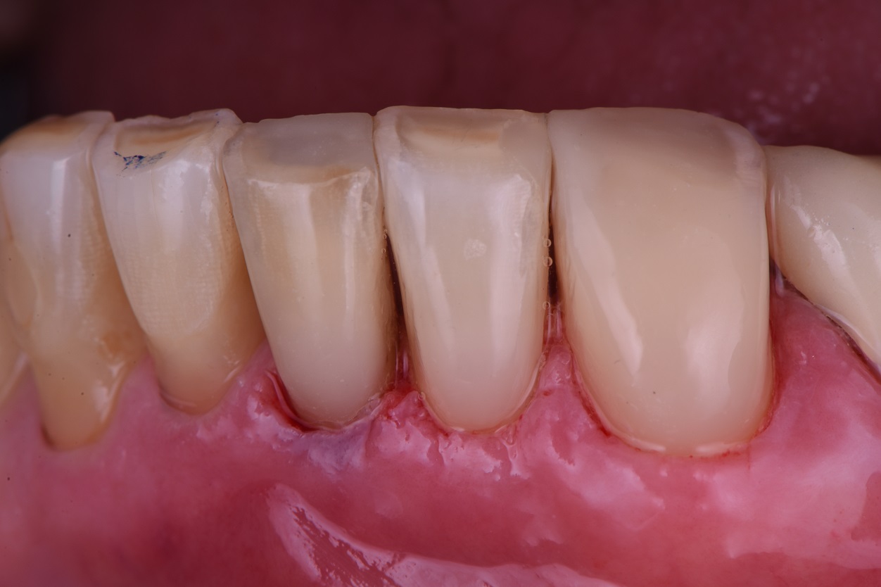 Hu-Friedy Akroflex | Garrison Fusion Anterior Matrix | Ultradent ...