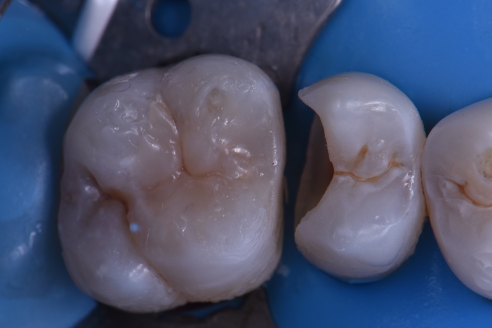 Deep cavities restored with Kerr Simplishade Garrison Compositight 3D ...
