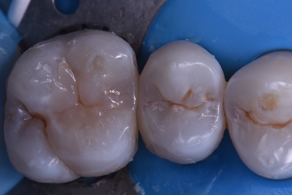 Deep cavities restored with Kerr Simplishade Garrison Compositight 3D ...
