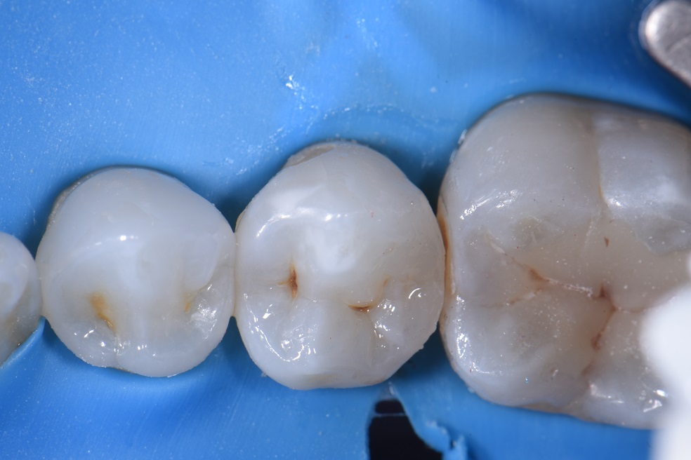 Small Slot Preps and Conservative Composite Restorations Small Slot ...