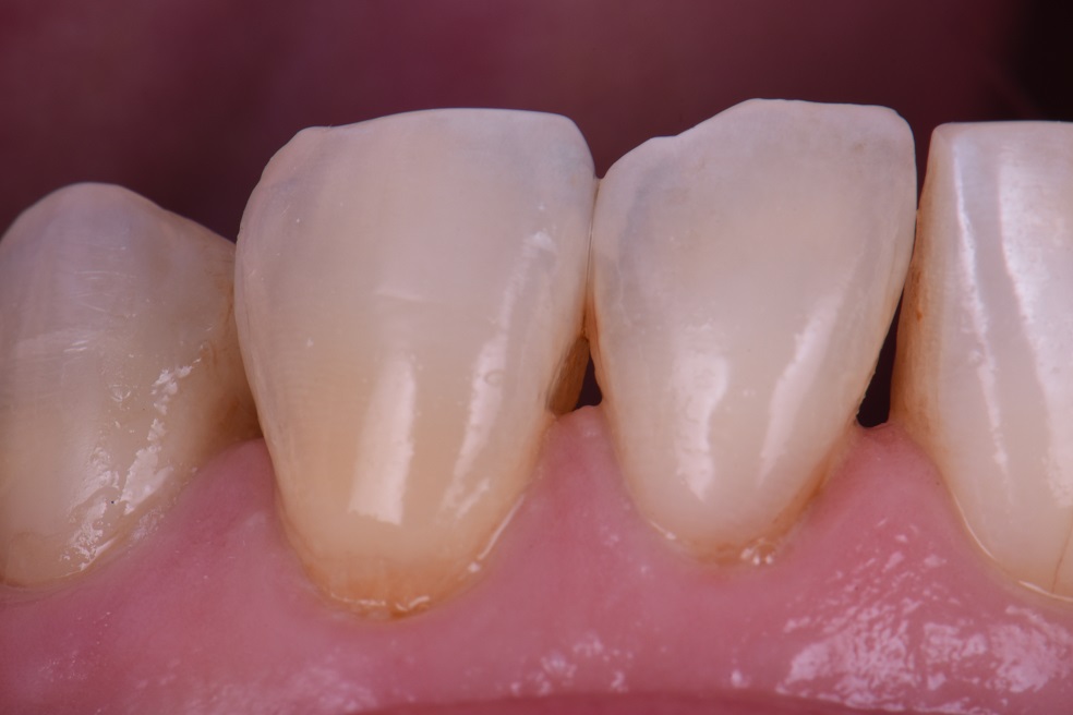 Invisible Class V Composite Fillings Invisible Class V Composite Fillings