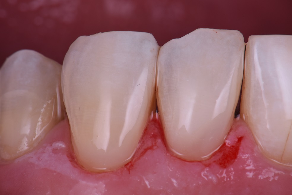 Invisible Class V Composite Fillings Invisible Class V Composite Fillings